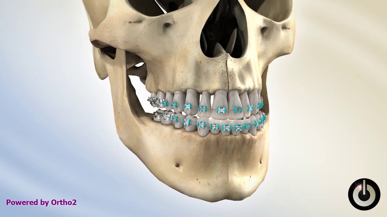 Surgery Mandibular Setback - Class 3 - YouTube