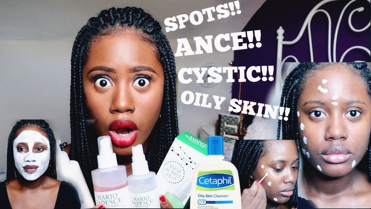 ACNE ON ONE SIDE OF MY FACE! VERY OILY SKIN ROUTINE! HELP!! - YouTube
