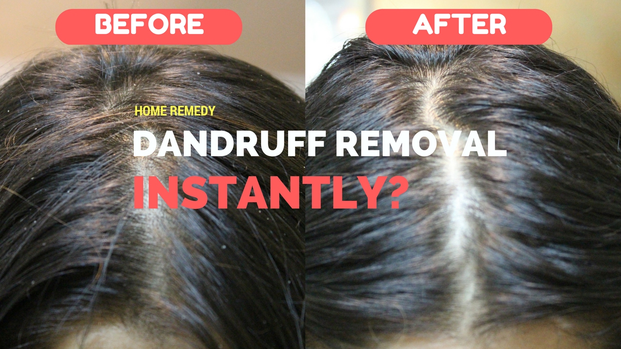 DANDRUFF REMOVAL TREATMENT AT HOME | INSTANT RESULTS | Only 2 ...