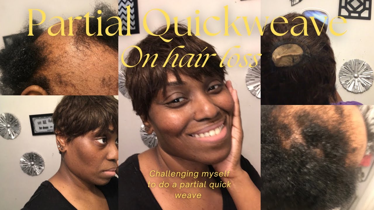 Partial Quick-weave Challenge on extreme hairloss - YouTube