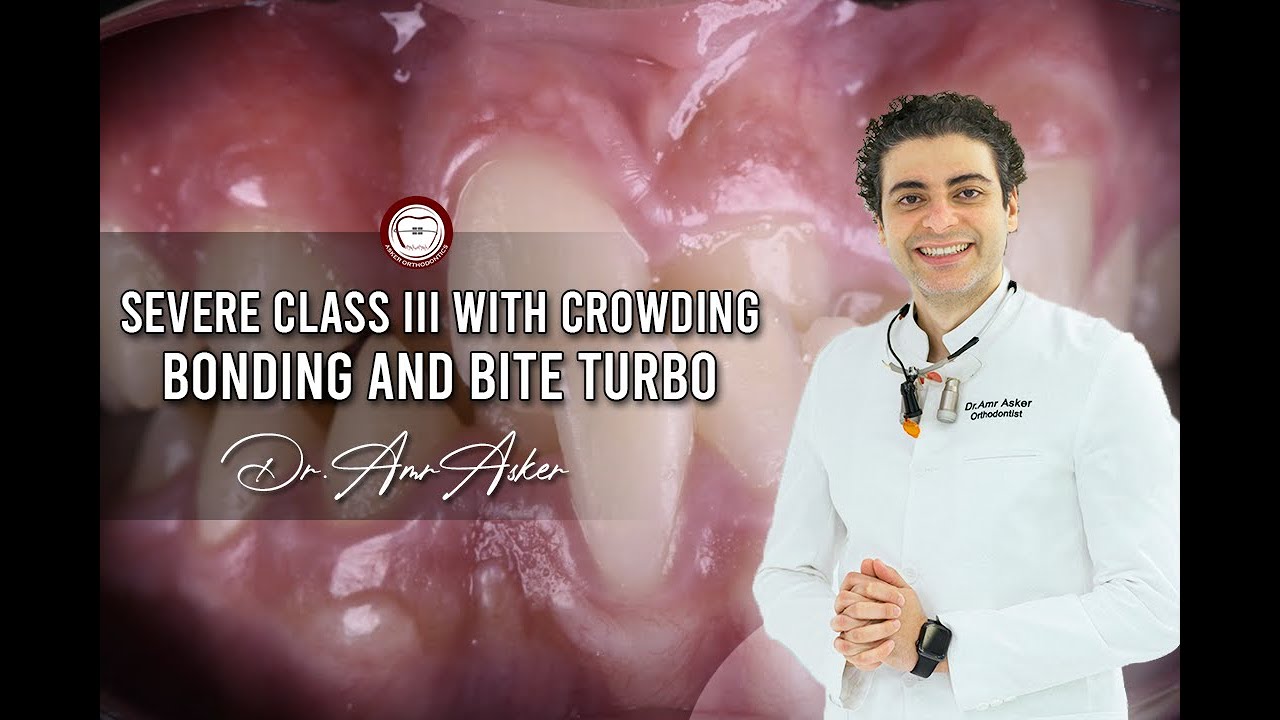 Severe class III with crowding, bonding and bite turbo placement - YouTube