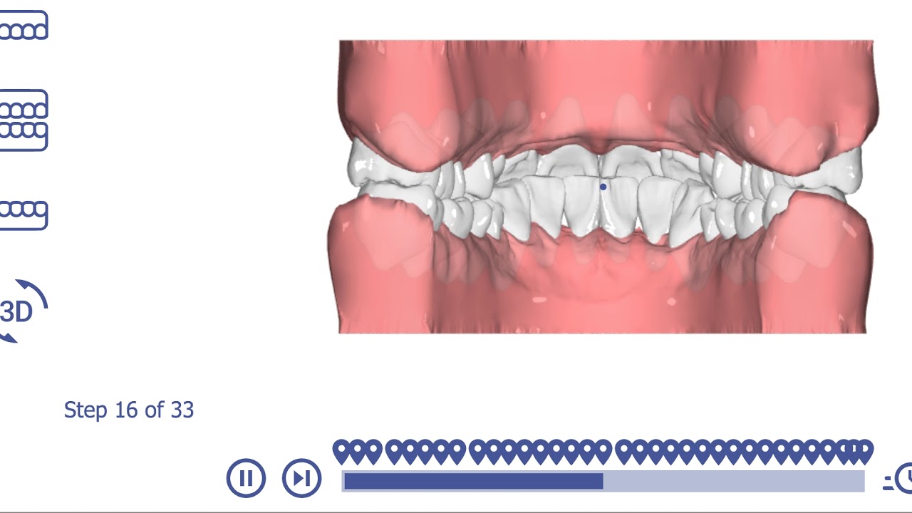 Case 3 Inner Jaw View - YouTube