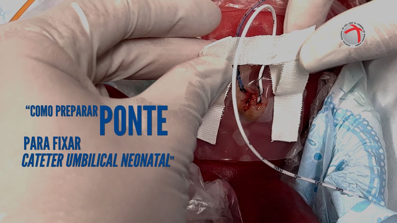 TUTORIAL : COMO PREPARAR E FAZER FIXAÇÃO EM CATETER UMBILICAL NEONATAL ...