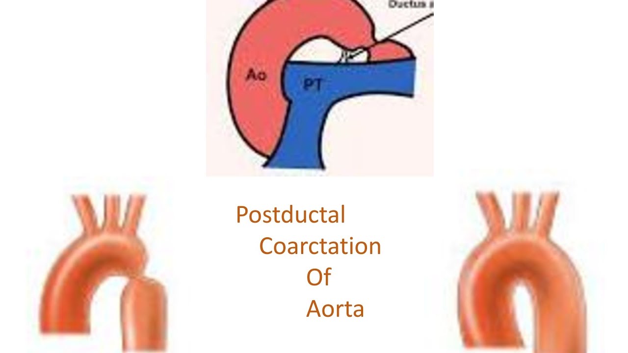 Adult type of Coarctation of aorta |COA | Mightymedicoz - YouTube