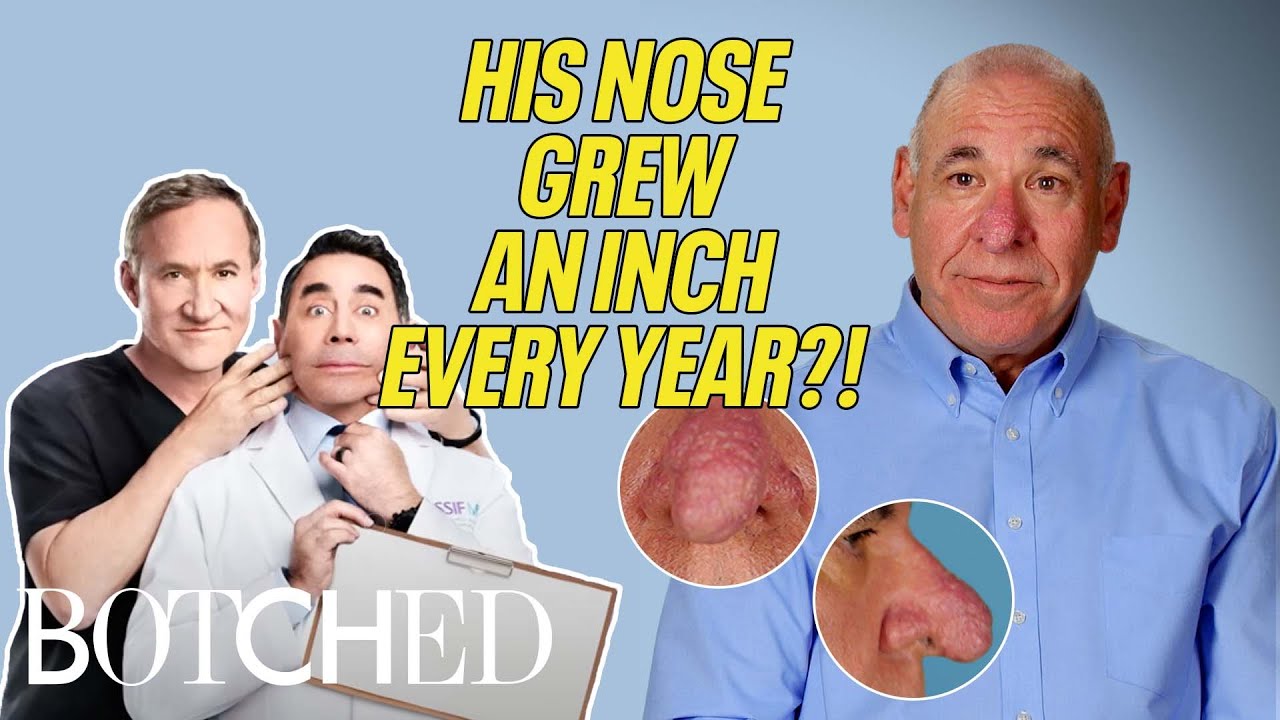 Dr. Nassif Has To Grate Andy's Nose Like Parmesan Cheese?! (Before ...