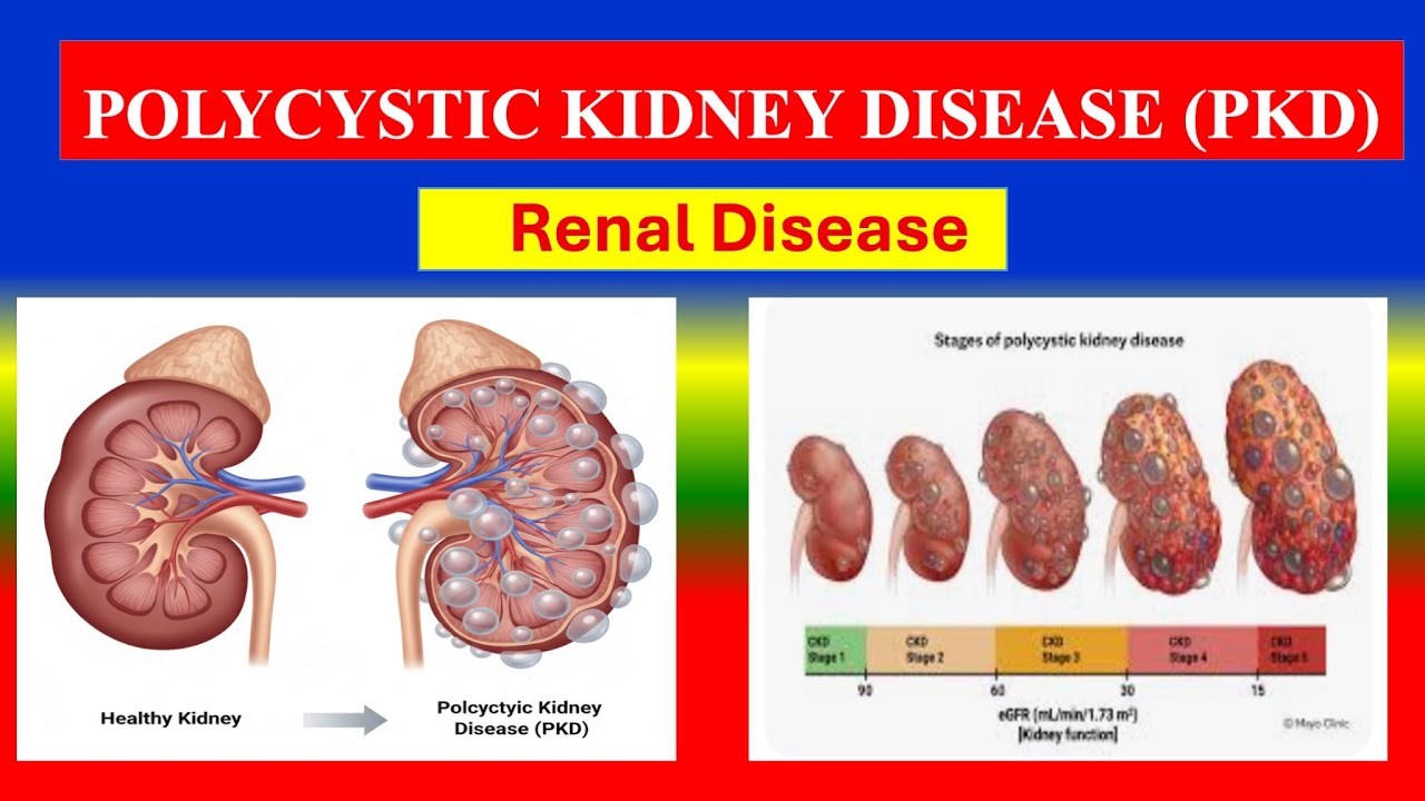 POLYCYSTIC KIDNEY DISEASE (PKD) Explained | Causes, Types, Symptoms ...