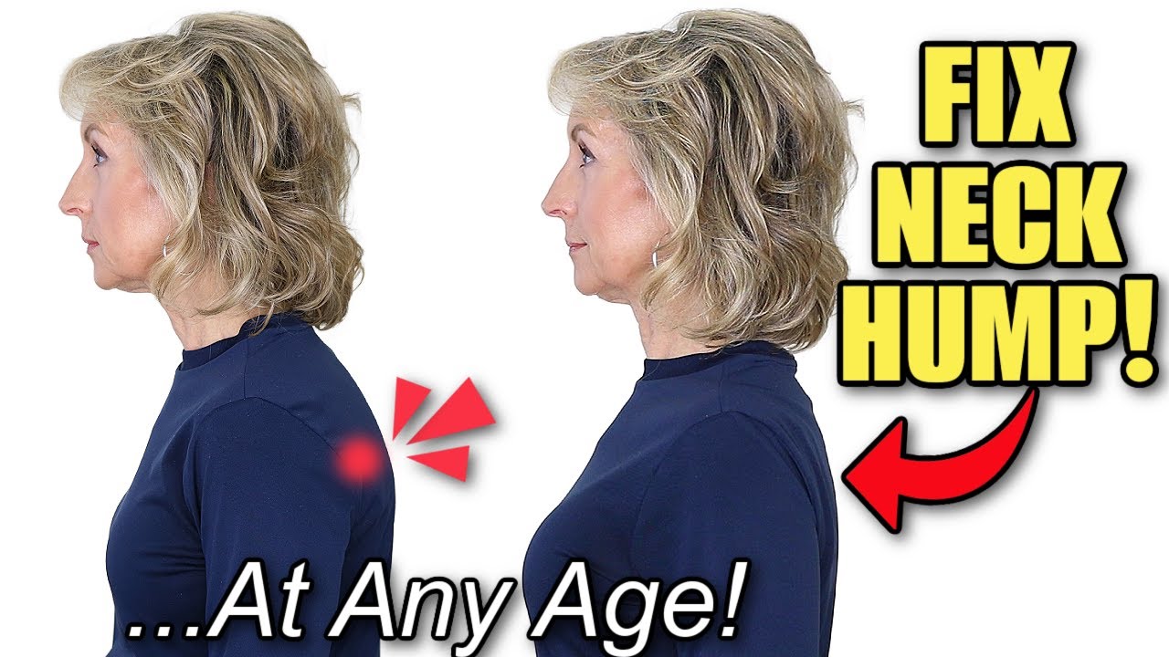 Get Rid of Neck Hump - Exercises to Fix It & Improve Posture - YouTube