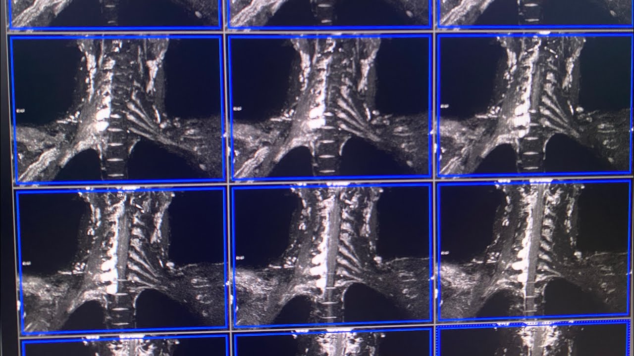 MRI of Brachial Plexus and neurography. post traumatic injury with ...