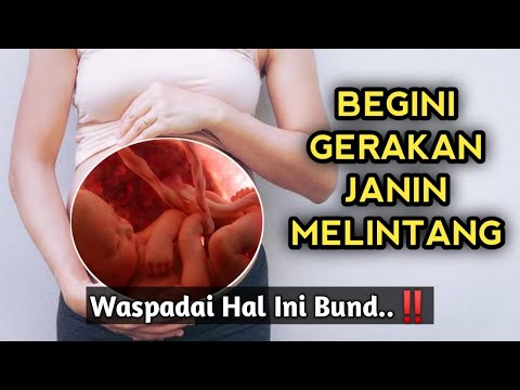Ciri-ciri Gerakan Janin Melintang didalam Rahim, Waspadai Hal Ini..