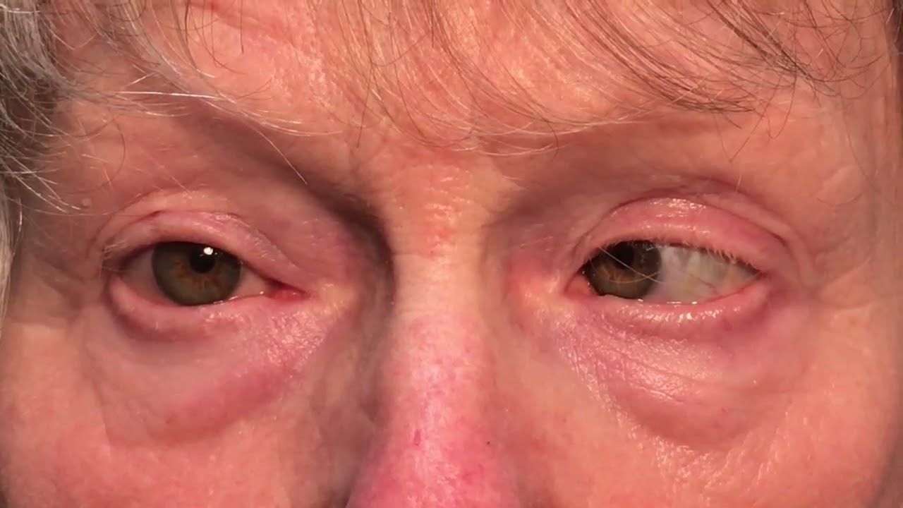 Cranial Nerve 6 Palsy