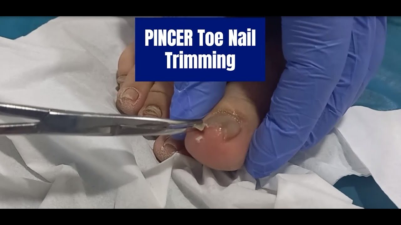 Non-Invasive Pincer (Uncut) Toenail Trimming: Effective Techniques and ...