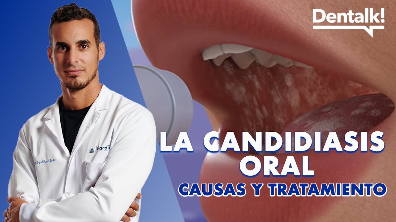 ¿HONGOS en la BOCA? Causas, prevención y tratamiento de la CANDIDIASIS ...