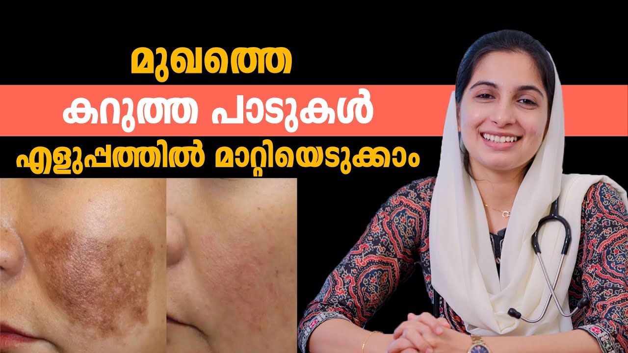 How to Get Rid of Facial Pigmentation Naturally | Skin Care Tips ...