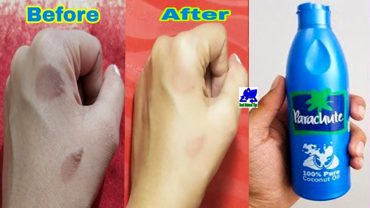 Best Way To Get Rid Of Old Burn Scars, Burn Marks Treatment, Burn Spots ...