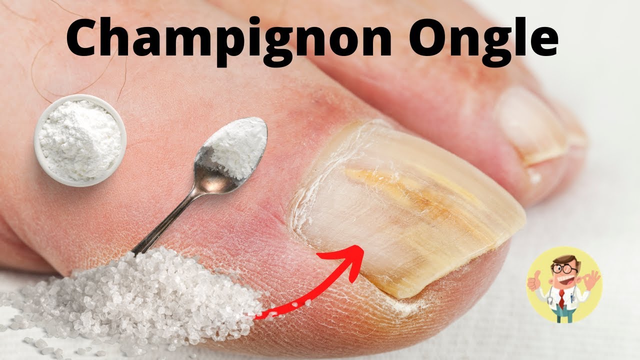 Champignon des ongles - Comment se débarrasser naturellement des ...