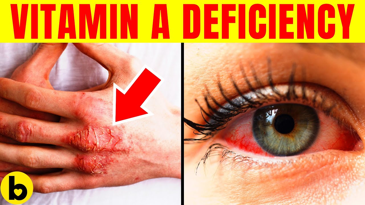 9 Sneaky Symptoms That Can Be A Sign of a Vitamin A Deficiency - YouTube