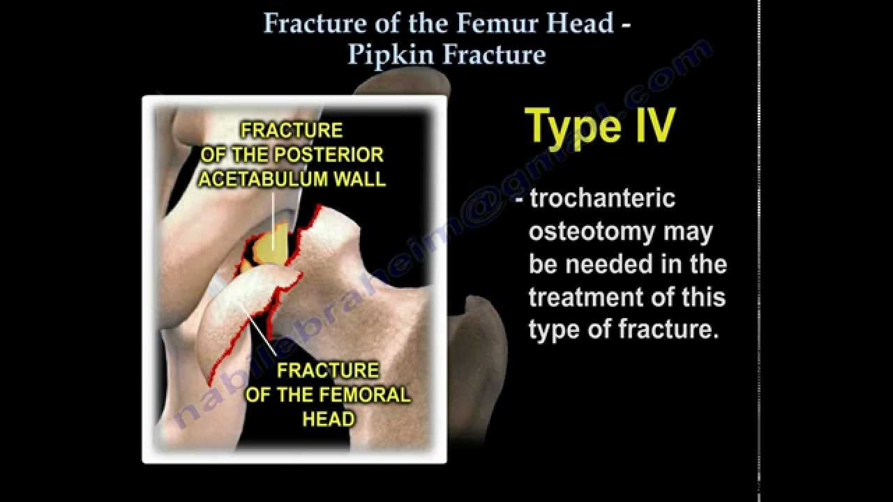 Fractures Of The Femur Head ,Pipkin Fracture - Everything You Need To ...