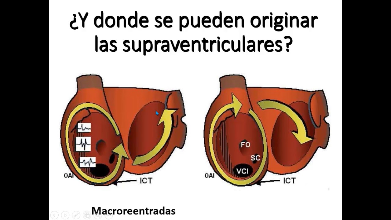 Presença De Ectopias Supraventriculares - RETOEDU