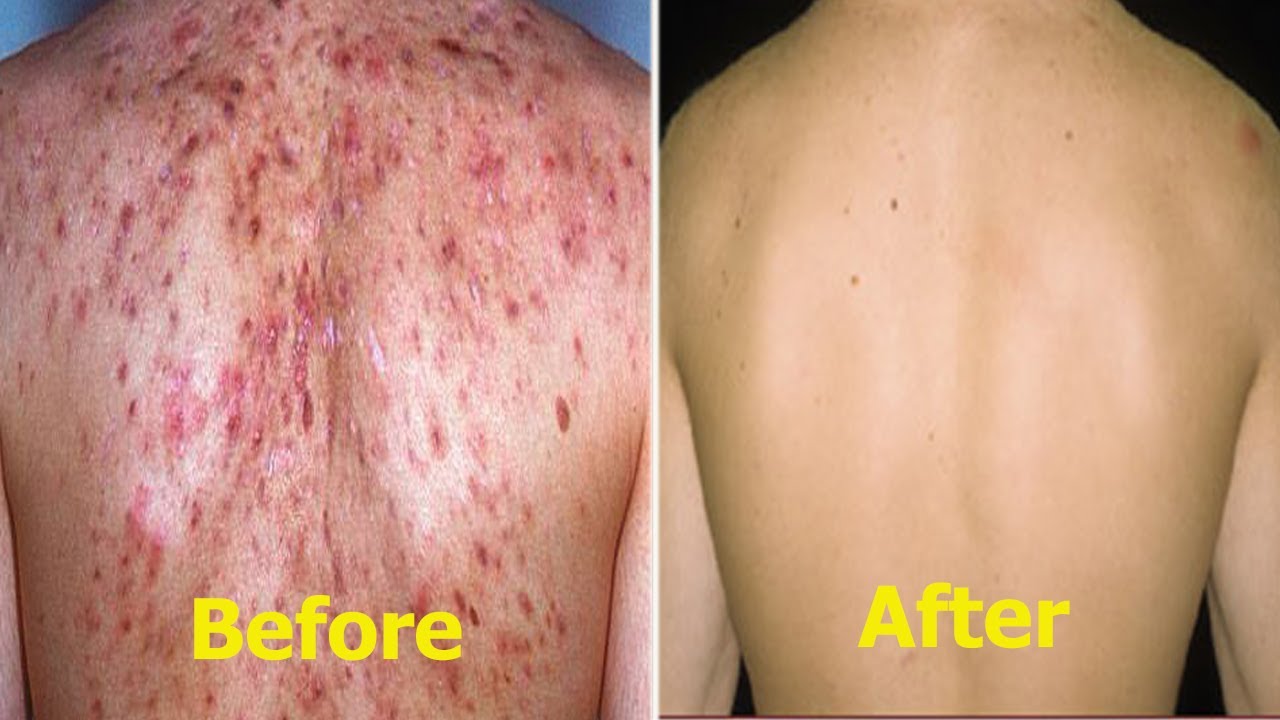 Get Rid Of Back Acne and Pimples In 30 Days - Get Smooth Back and Clear ...