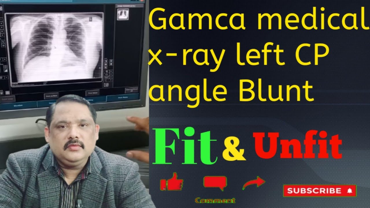 CP Angle Blunt X-ray Explained | GAMCA Medical Test Guidelines"2025 ...