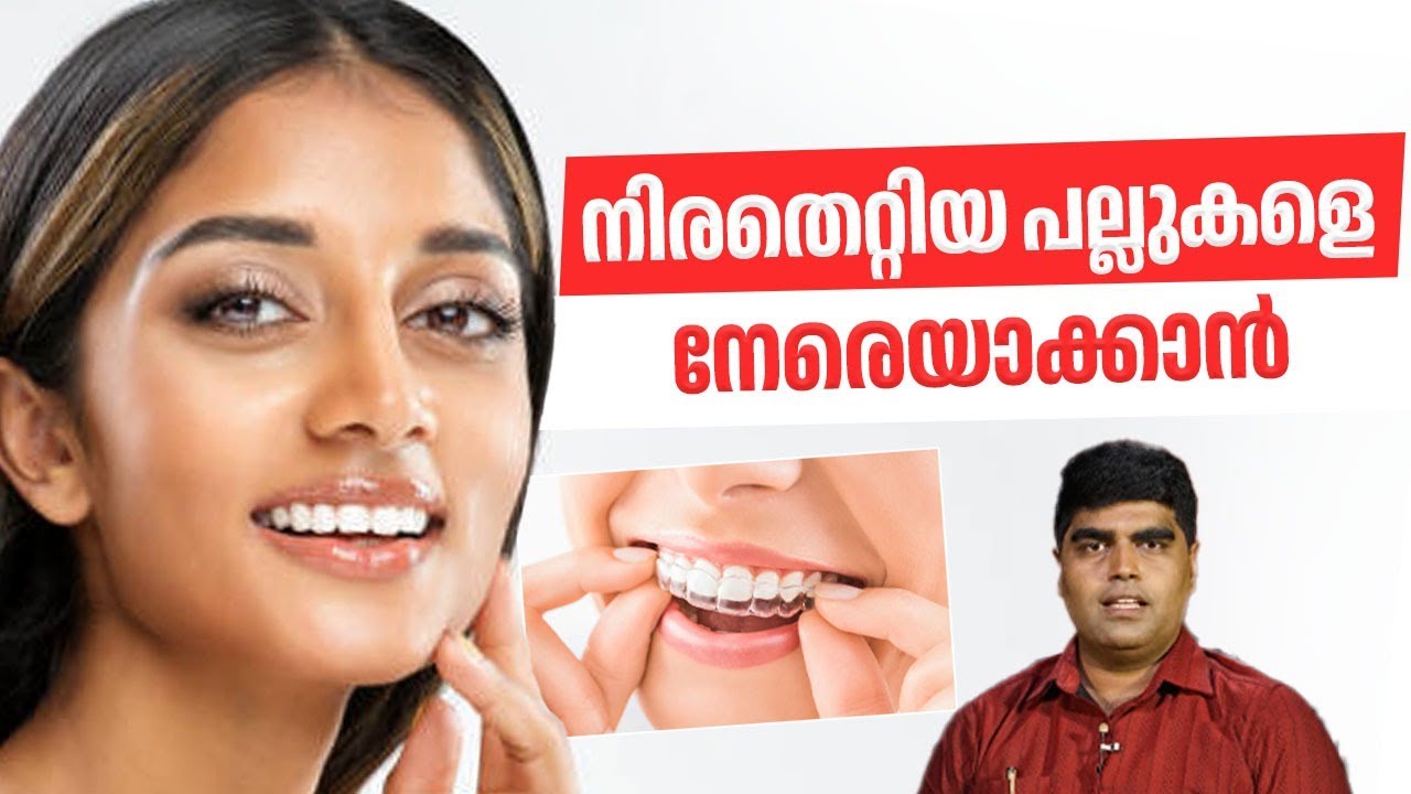നിരതെറ്റിയ പല്ലുകളെ നേരെയാക്കാൻ | Teeth alignment treatment | Perfect smile makeover | Dental ...