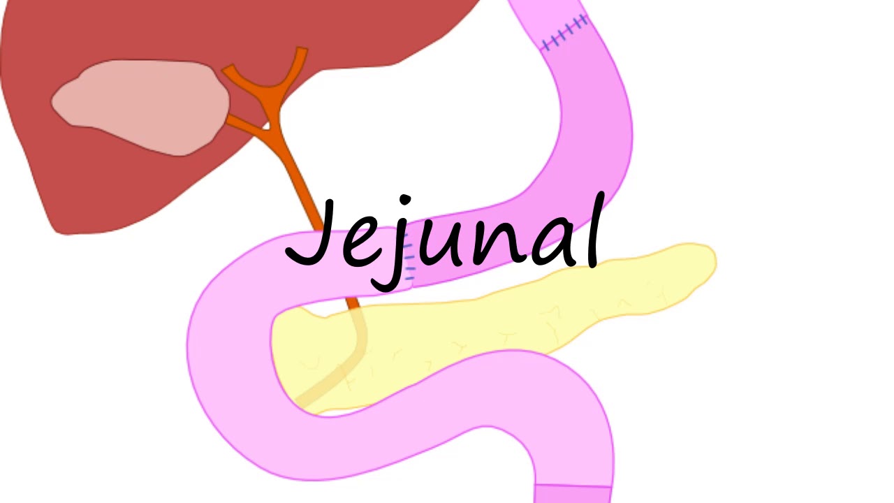 How to Pronounce Jejunal? - YouTube