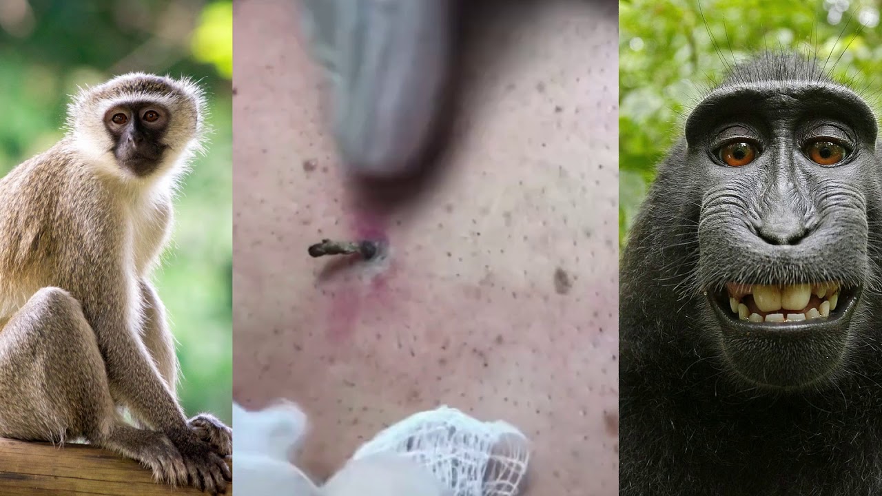 Top Pimple TV, how to remove blackheads, Part #67 - YouTube