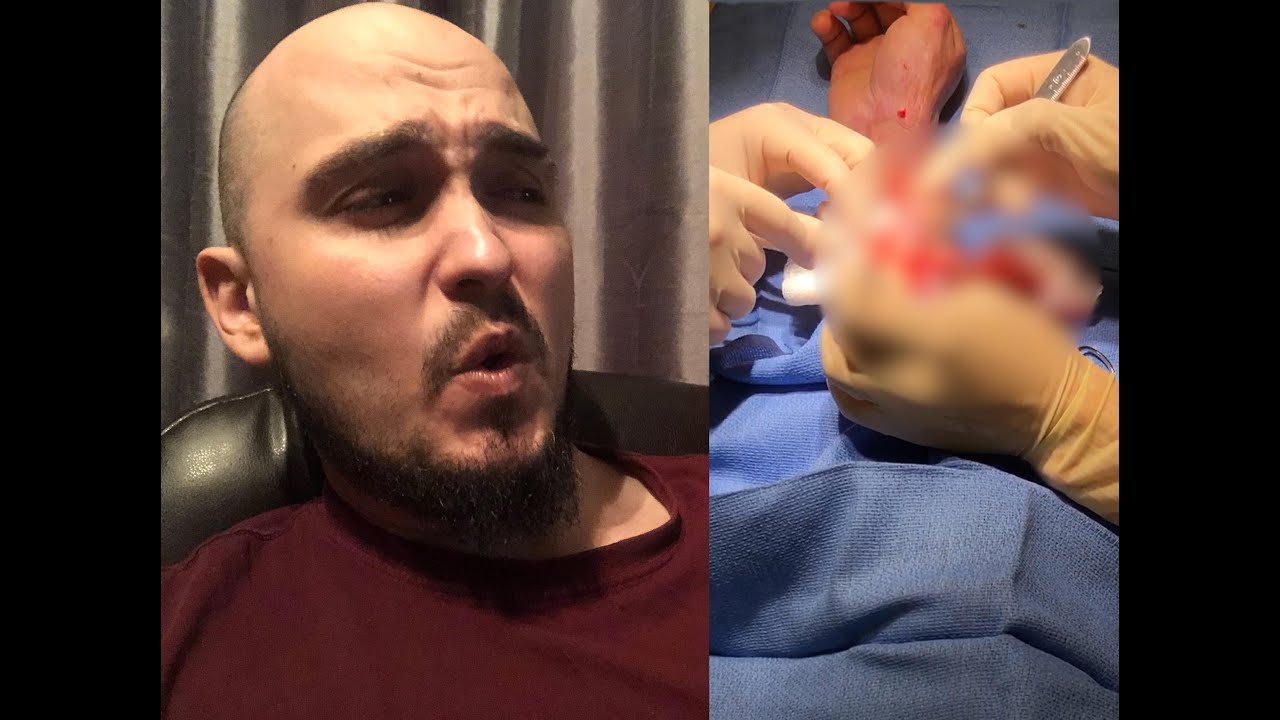 My "Z-plasty" scar surgery *GROSS* (Burn Survivor | Amputee) - YouTube