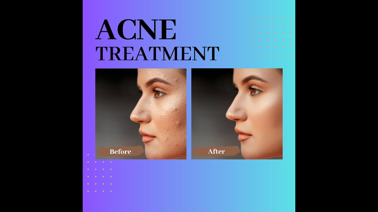 Acnevit serum //How to use acne //best cream/skin health care - YouTube