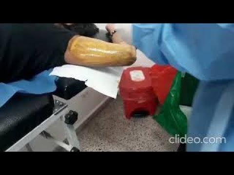 Inserción de Jadelle - YouTube