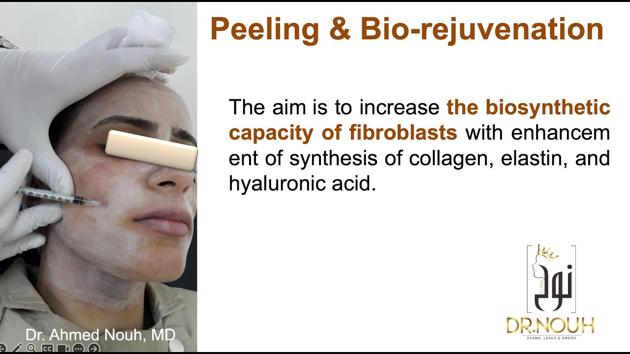 Chemical peeling part 3 - YouTube