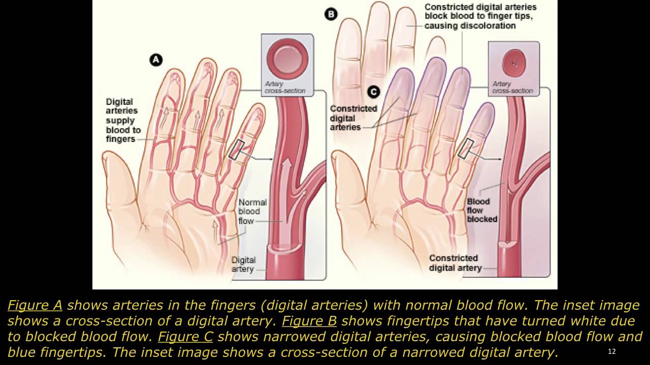 raynauds disease - YouTube