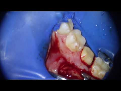 Cortical trephination with Pus drainage - YouTube