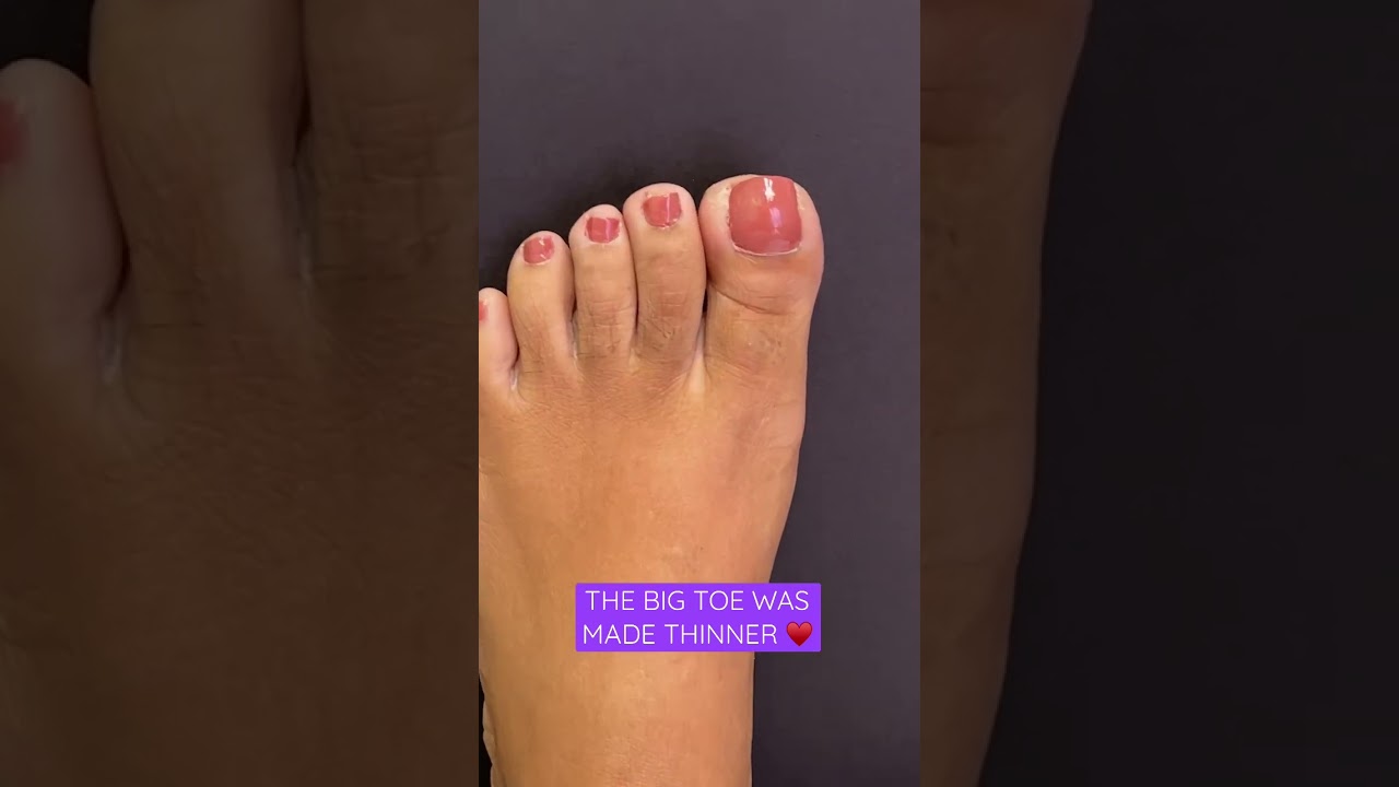TOE TUCK SURGERY FOR TOEBESITY 🔥#shorts #cosmeticfootsurgery - YouTube