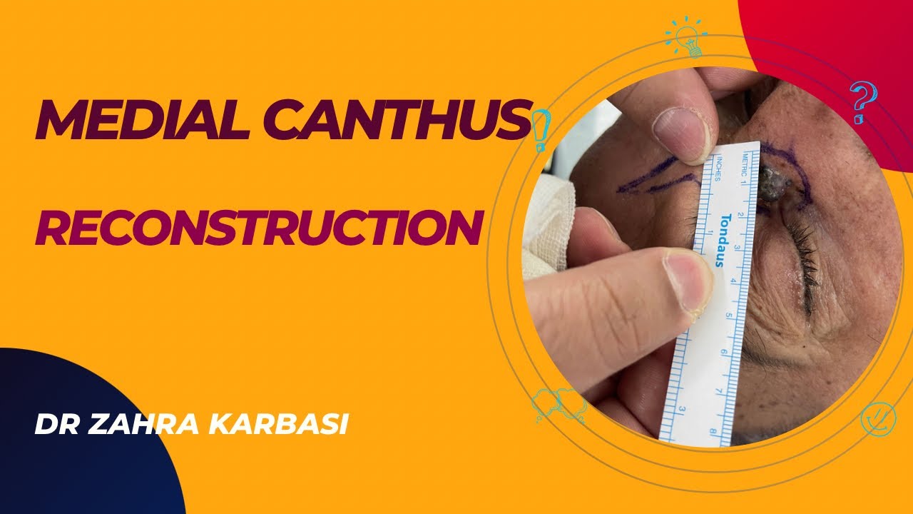 Medial canthus reconstruction | glabellar flap - YouTube
