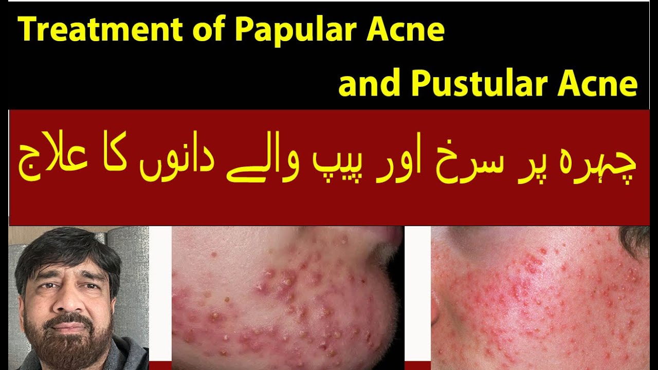 How to Get Rid of Pustules & Papules: Best Treatments for Red Acne ...