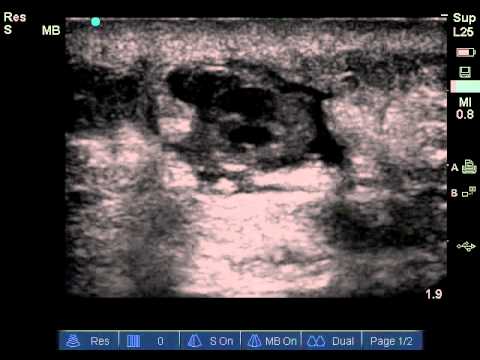 ABSCESS Loculations WITH PUSTALSIS 2 crop - YouTube