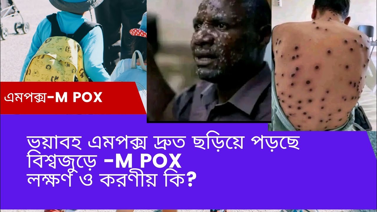 ভয়াবহ এমপক্স দ্রুত ছড়িয়ে পড়ছে বিশ্বজুড়ে -M POX! লক্ষন ও করণীয় কি ...