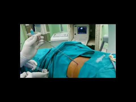 Ultra Mini PCNL for kidney stone with Laser - YouTube