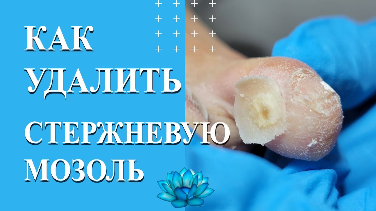 Стержневая мозоль на пальце. Удаление стержневой мозоли. - YouTube