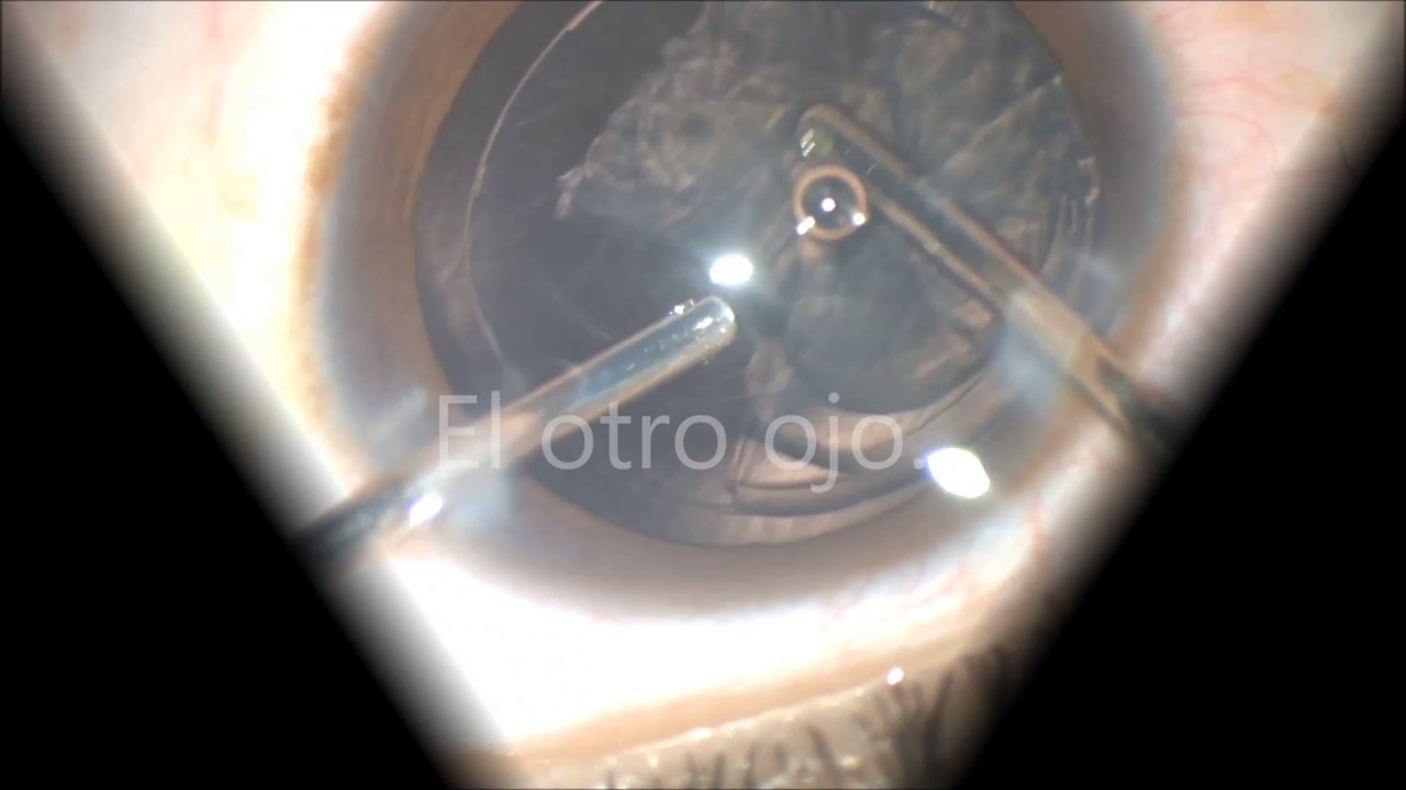 Microspherophakia and Restor with optic capture - YouTube