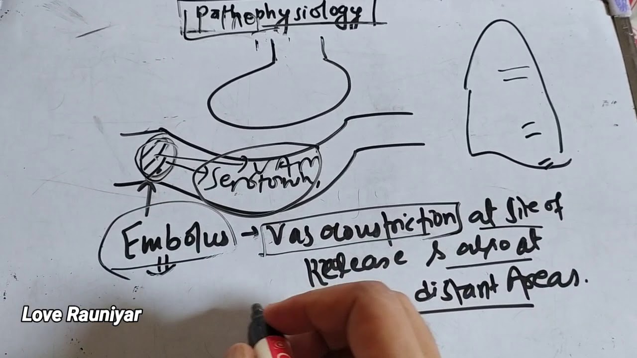 Pulmonary Embolism part 2(Pathophysiology and clinical features) - YouTube
