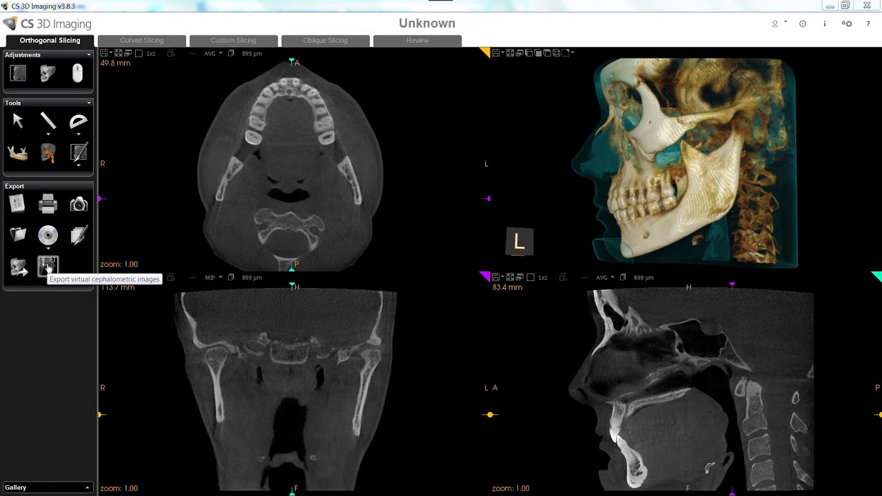 Carestream Dental's CS 3D Imaging Version 3 8 New Features 1 - YouTube