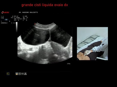 grande cisti liquida all'ovaio destro - tecnica ecografica - YouTube