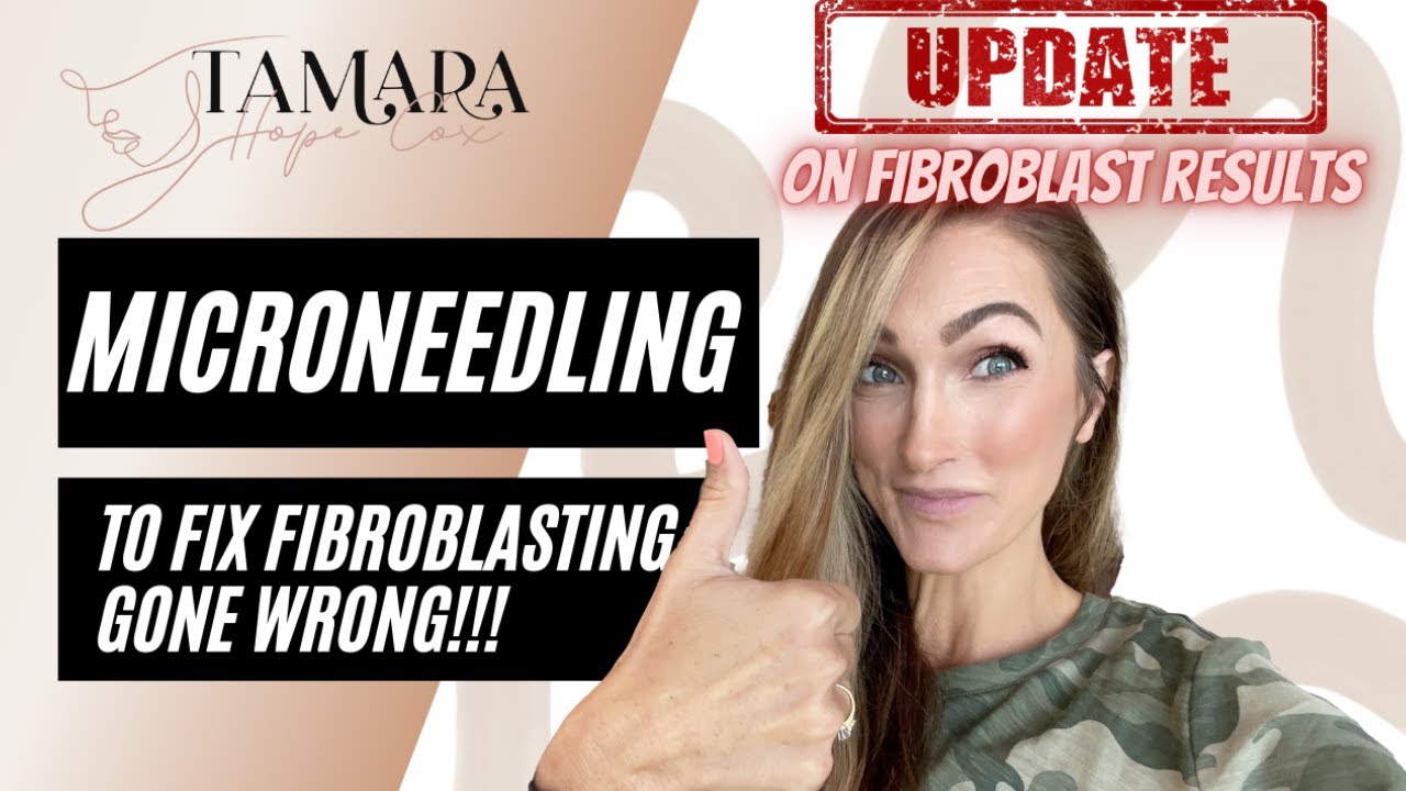 Microneedling to Remove Plasma Fibroblast Scarring - YouTube