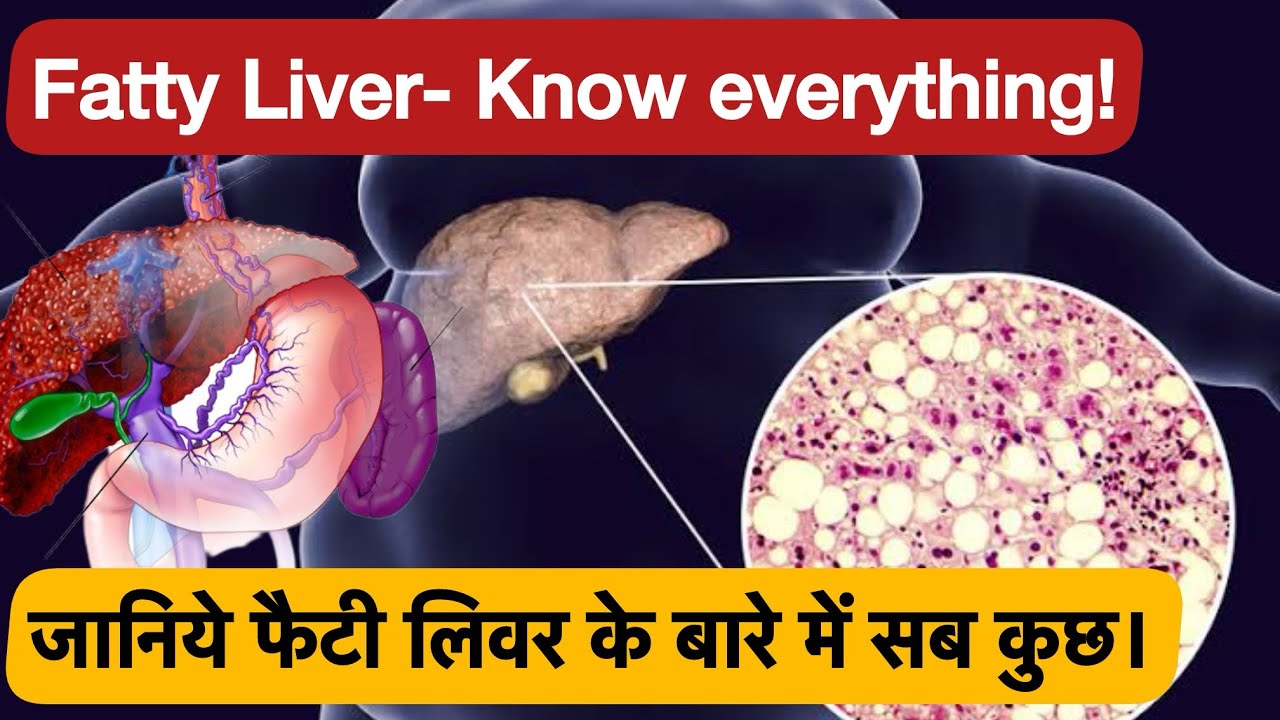 Fatty liver in detail- Causes, risk factors, treatment, complications ...