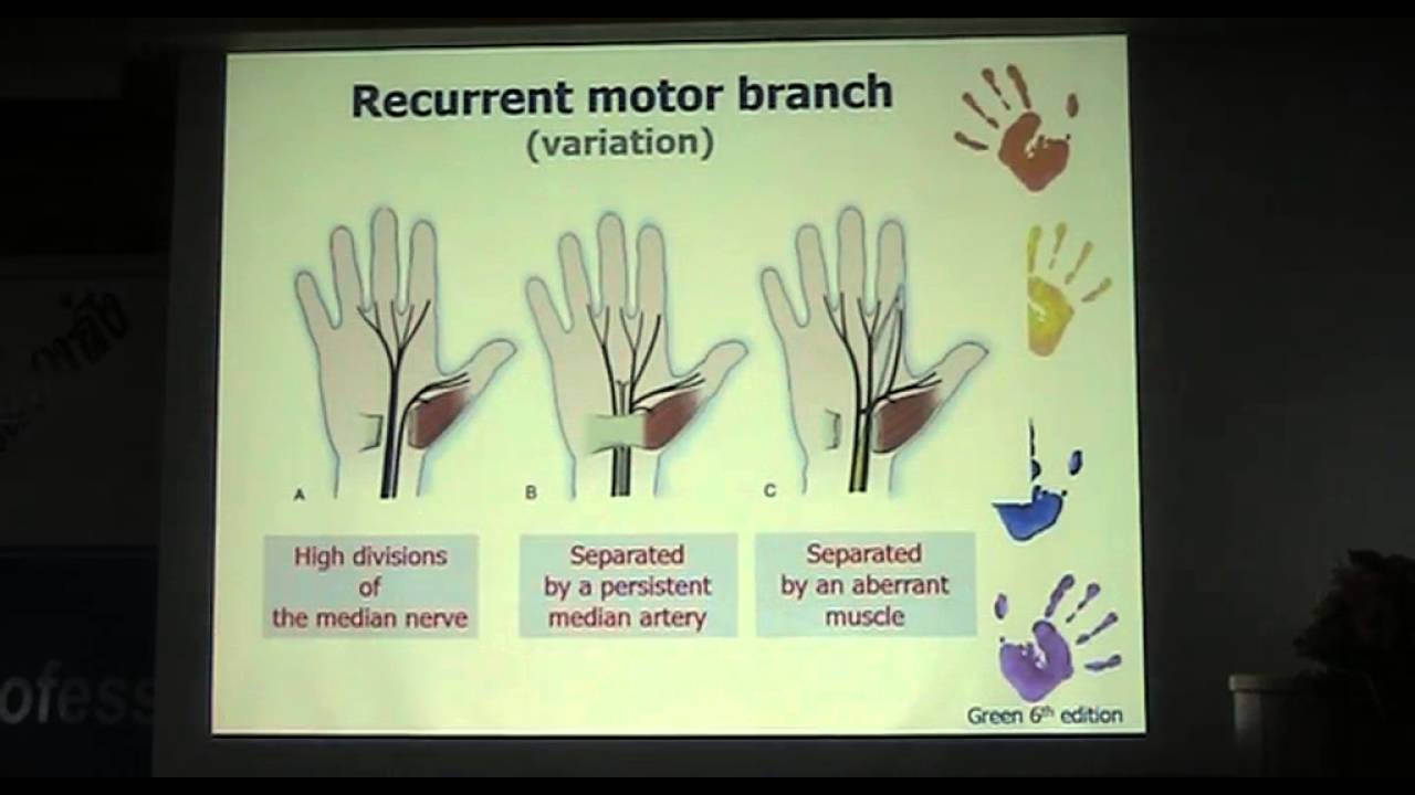 Failed Hand Surgery 1 - YouTube