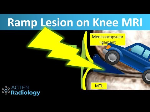 Ramp lesions on knee MRI - YouTube