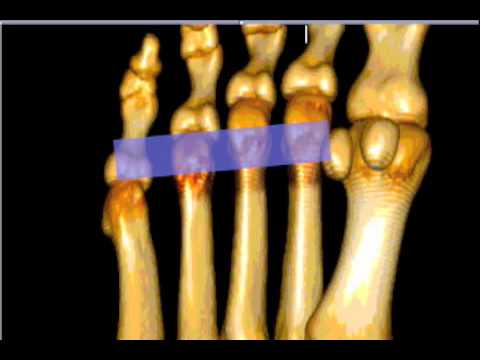 How To: Morton's Neuroma Case Study Video - YouTube