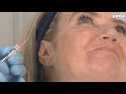 Dalvi Humzah demonstrates the five bio-aesthetic point (BAP) injection ...